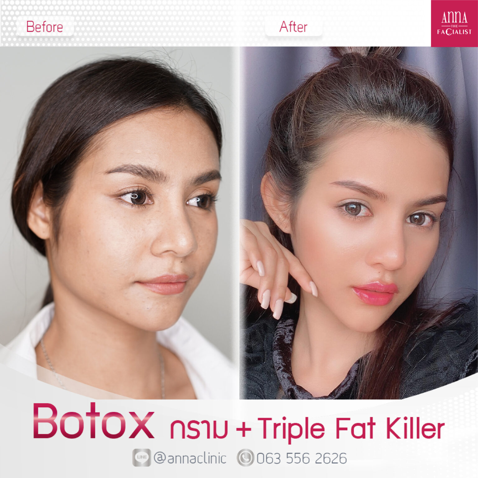 รีวิว Nabota Botox และ Triple Fat Killer จากคุณพิ้งค์ | Anna Clinic ...