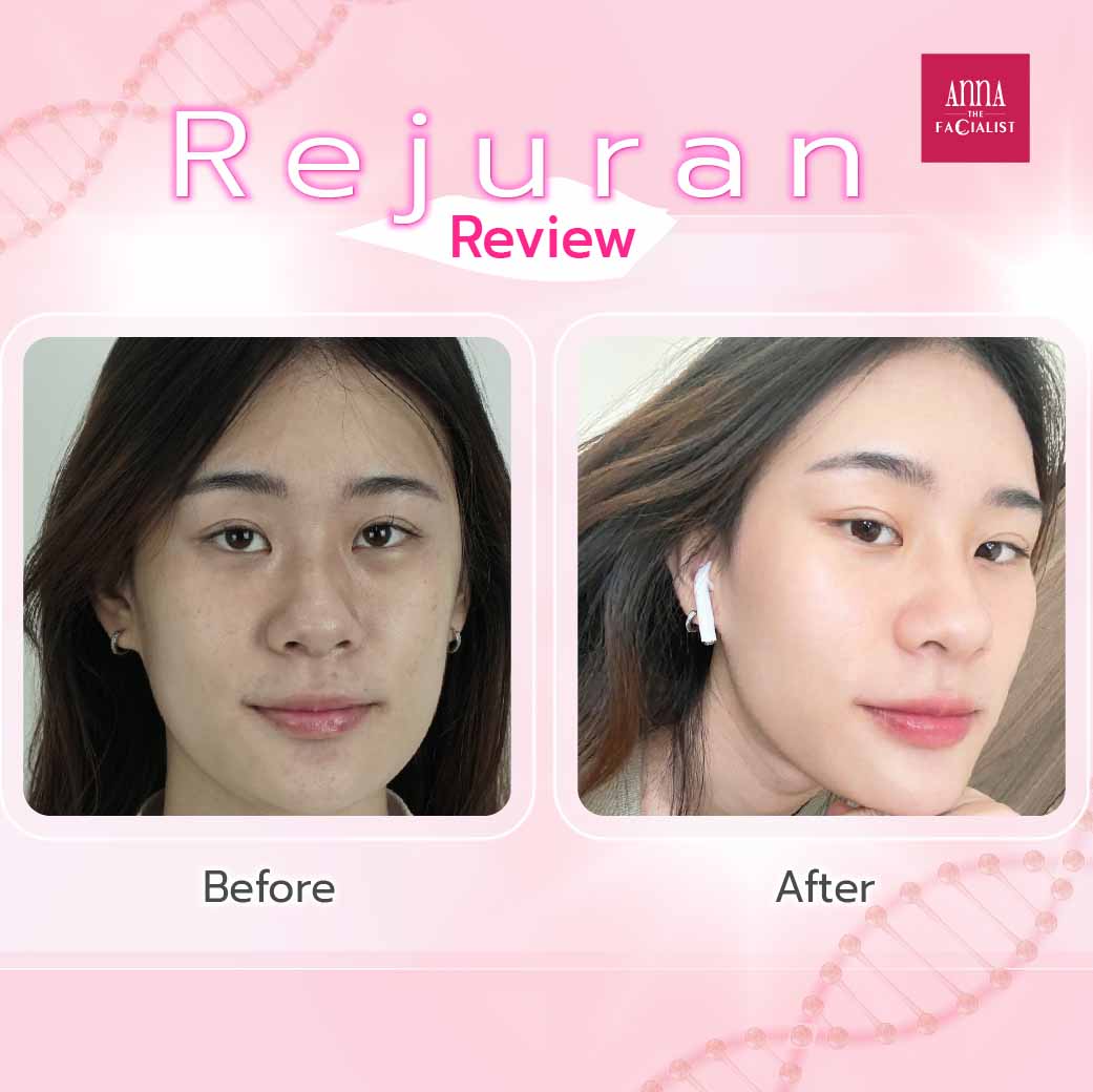 Rejuran | Anna Clinic