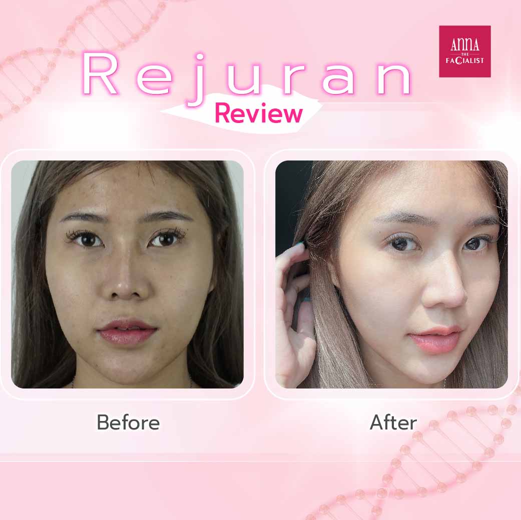 Rejuran | Anna Clinic