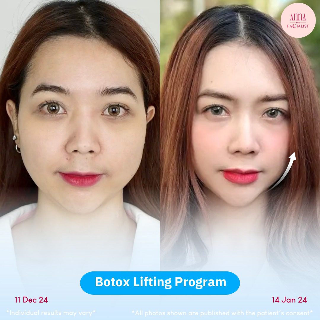 Botox V Shape | Anna Clinic