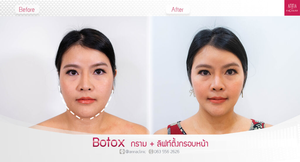 Botox Lifting 3D Archives | Anna Clinic