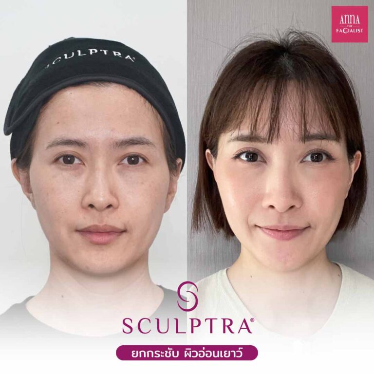Sculptra นวัตกรรมกระตุ้นคอลลาเจน ยกกระชับ ลดเลือนริ้วรอย | Anna Clinic